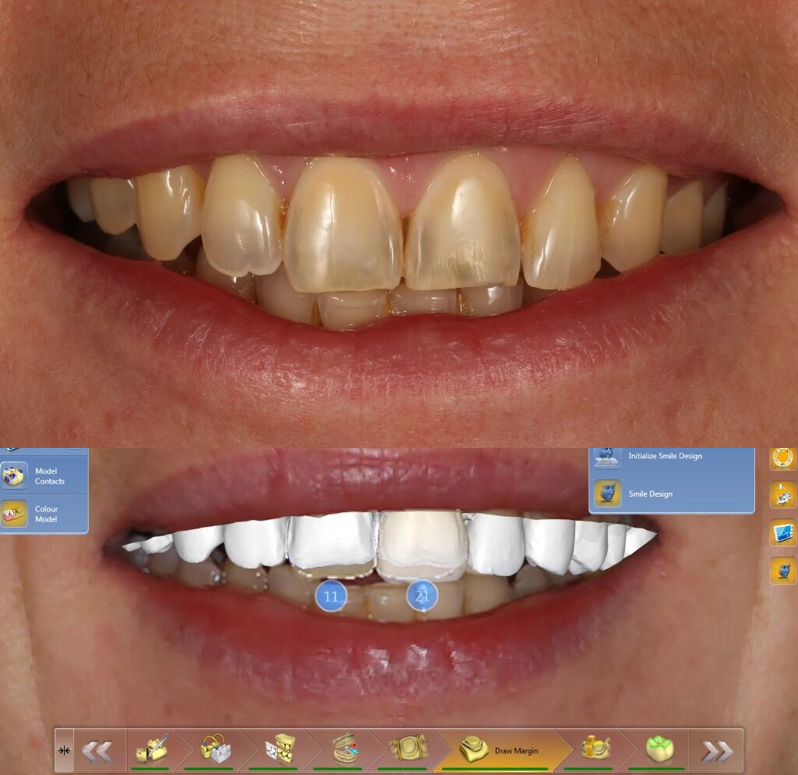 Bleaching,Veneers, Invisalign - Startseite
